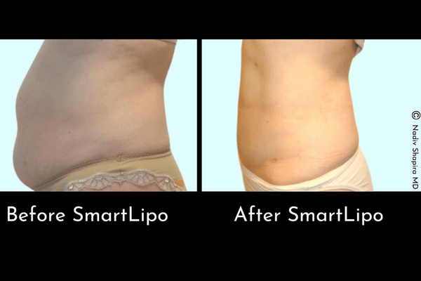 Smartlipo Wilmington Delaware Near Me