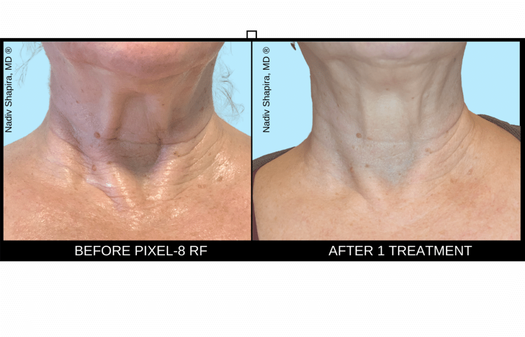 Pixel RF Microneedling Wilmington & Near Me | Microneedling