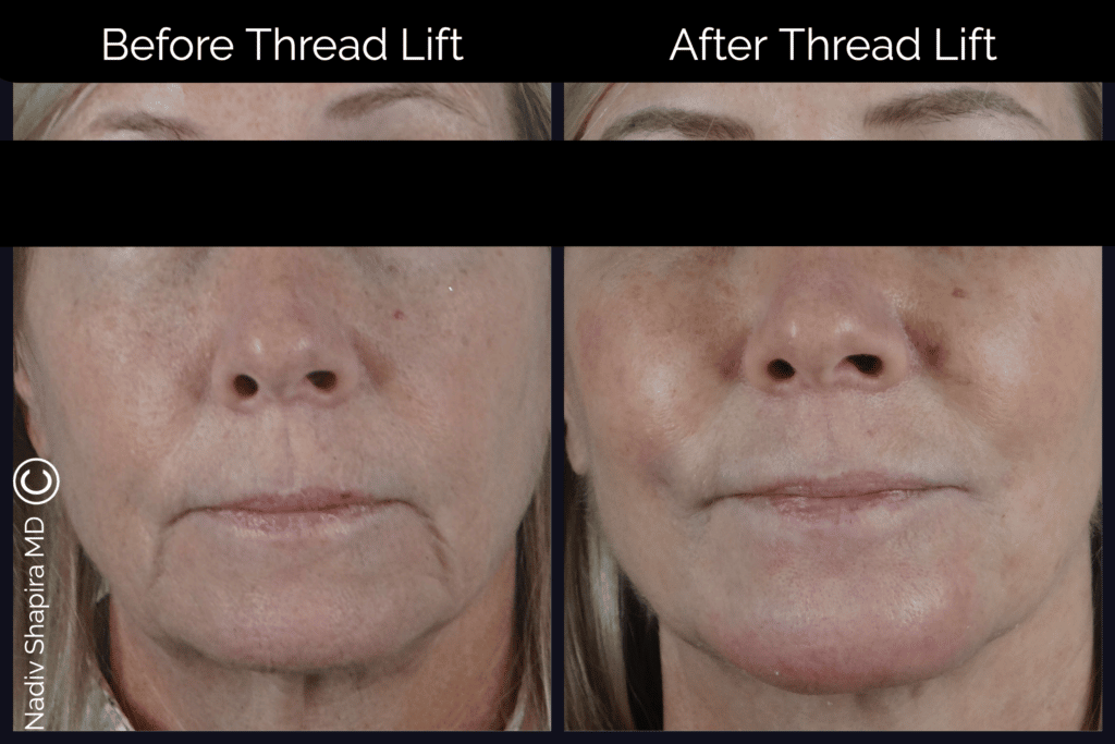 PDO Thread Lifts Wilmington, DE & West Chester, PA | Facial Threading